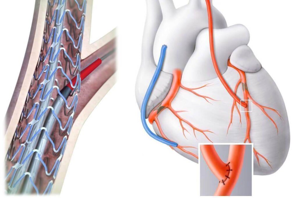 Stent mi, Bypass mı? - Prof. Dr. Şükrü Akyüz - Girişimsel Kardiyolog