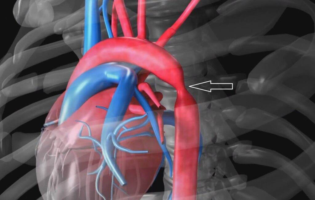 Aort Koarktasyonu - Prof. Dr. Şükrü Akyüz - Girişimsel Kardiyolog