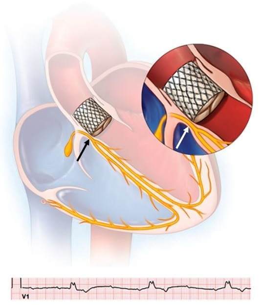 TAVI Yöntemi - Prof. Dr. Şükrü Akyüz - Girişimsel Kardiyolog 2025
