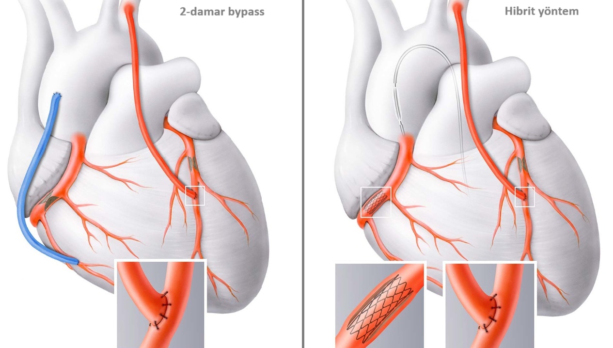 Stent mi, Bypass mı? - Prof. Dr. Şükrü Akyüz - Girişimsel Kardiyolog